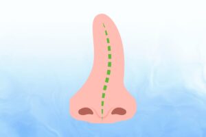 Deviated Nasal Septum (DNS): Symptoms & Treatment Options
